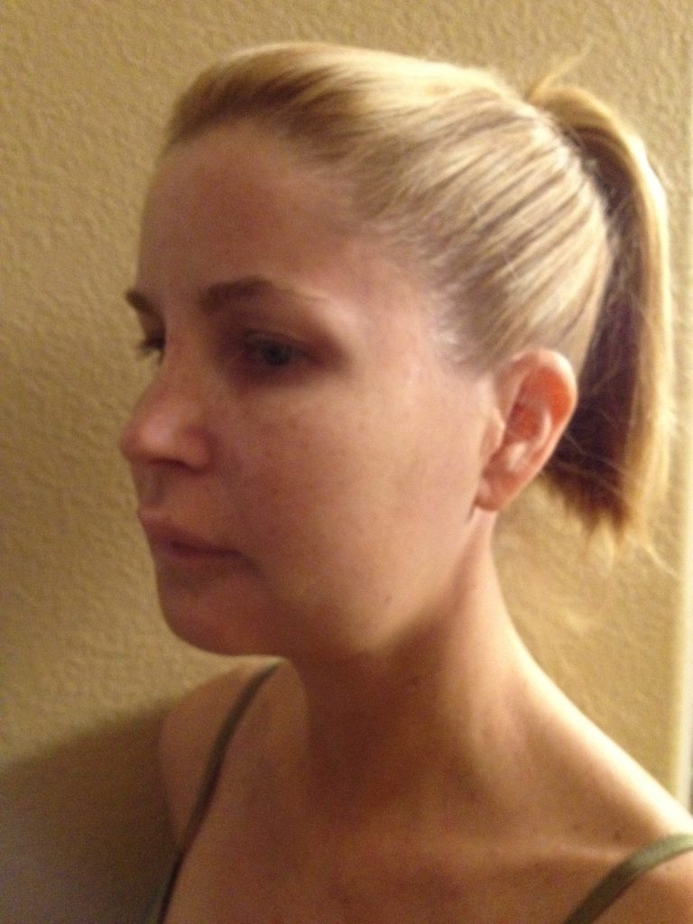 A Singer’s Worst Nightmare: Jaw Surgery a Decade Later – All Articles